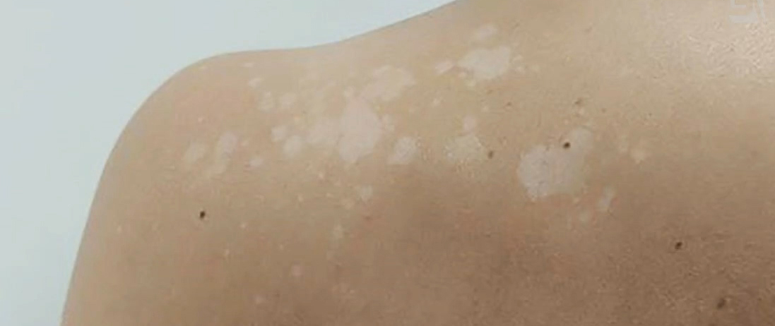 Causas de manchas brancas na pele - TV Gazeta - Você por perto. Tudo certo!