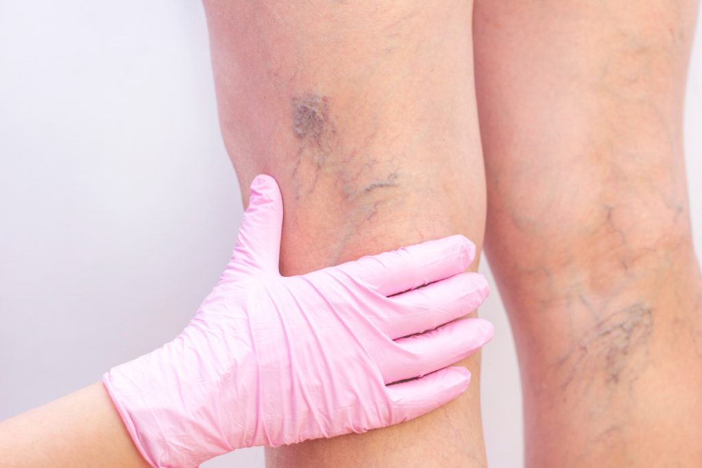 Entenda tudo sobre as varizes - TV Gazeta - Você por perto. Tudo certo!