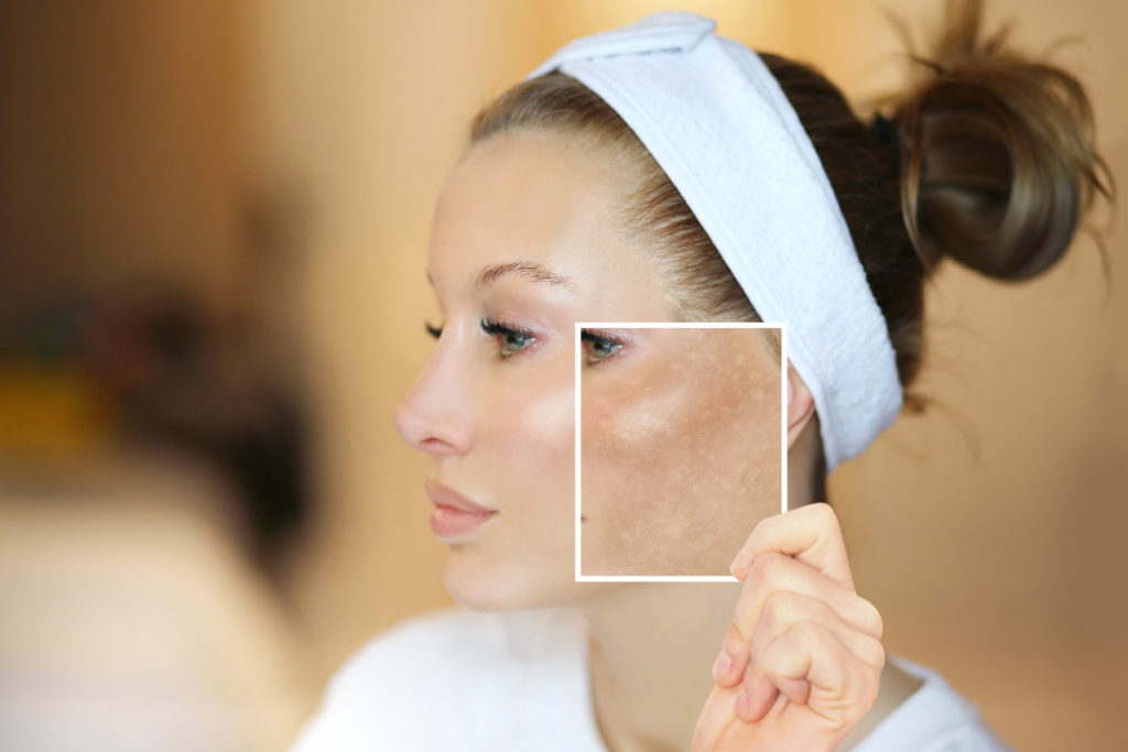 Melasma corporal: saiba o que é e o tratamento adequado - TV Gazeta ...
