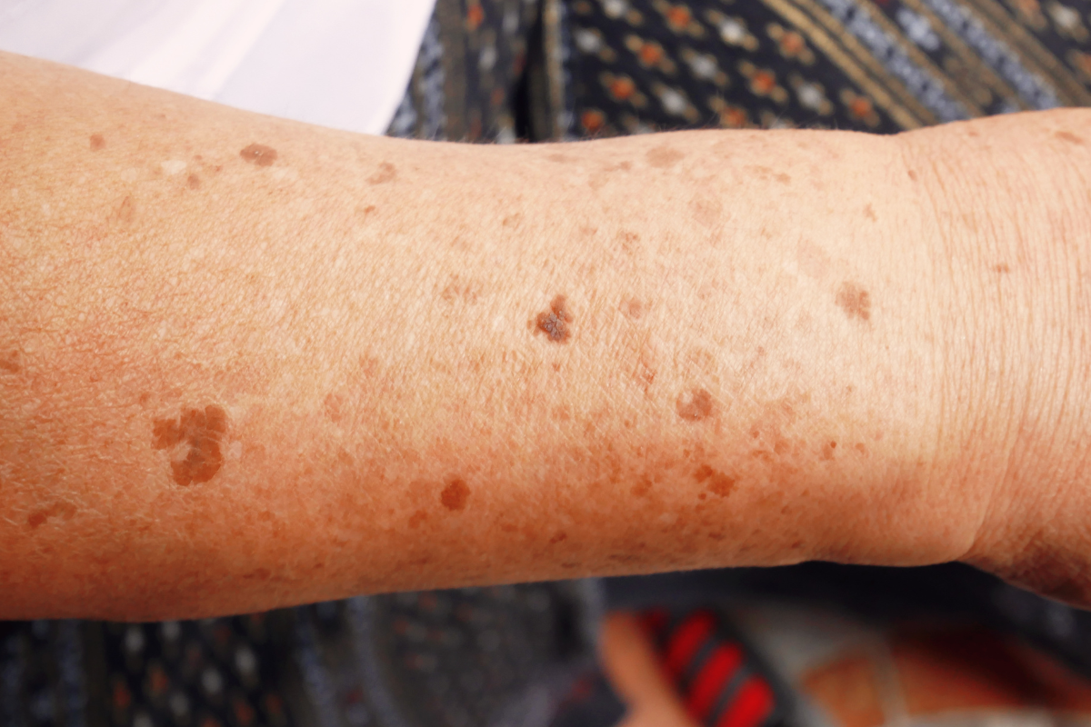 Manchas na pele: tipos, causas, prevenção e tratamentos - TV Gazeta ...